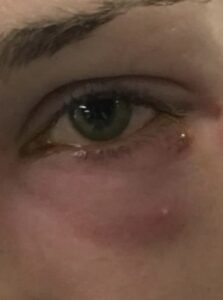 Augenherpes - Ursachen, Symptome und Behandlung